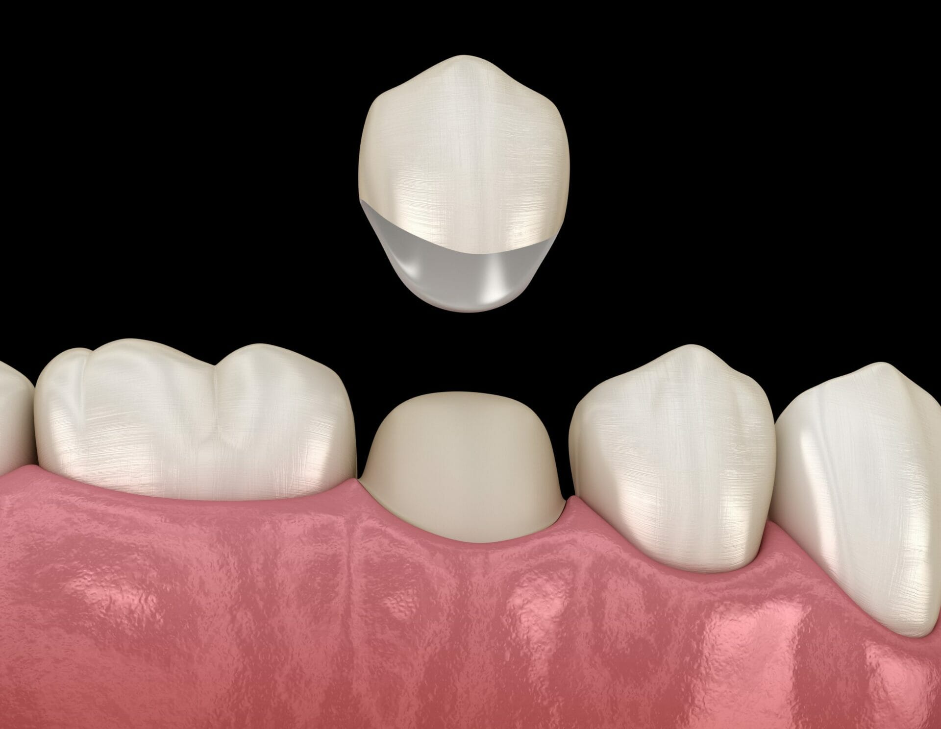 How do Dental Crowns work? ? ENAMEL REPUBLIC